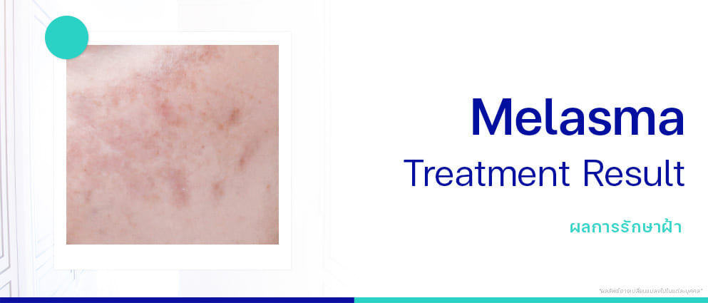 ภาพการรักษาฝ้า - ศูนย์เลเซอร์ผิวหนัง