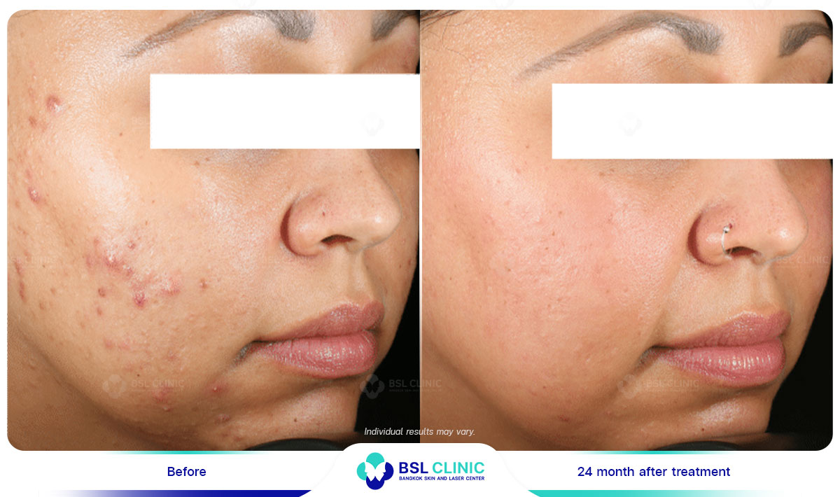 Accure Laser Program เลเซอร์รักษาสิวจากสาเหตุ ลดต่อมไขมัน